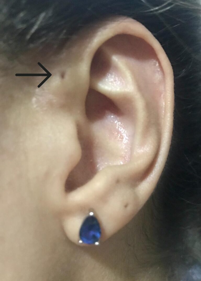 Seio pré-auricular: Malformação congênita está presente em até 10% da ...